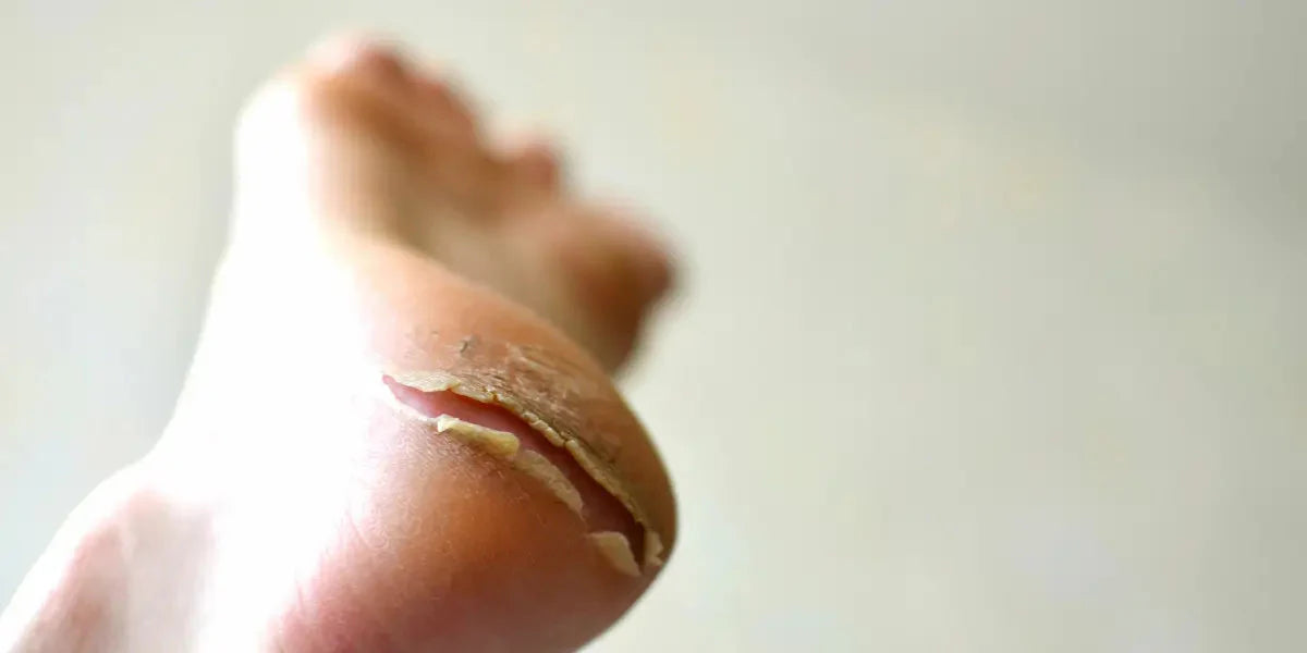 Antiscar : traitement innovant des ulcères et escarres chroniques